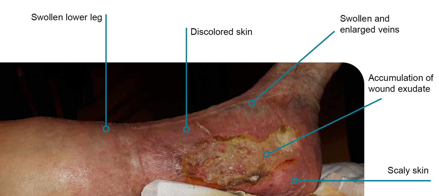 What Does a Venous Leg Ulcer Look Like? | Symptoms & Care