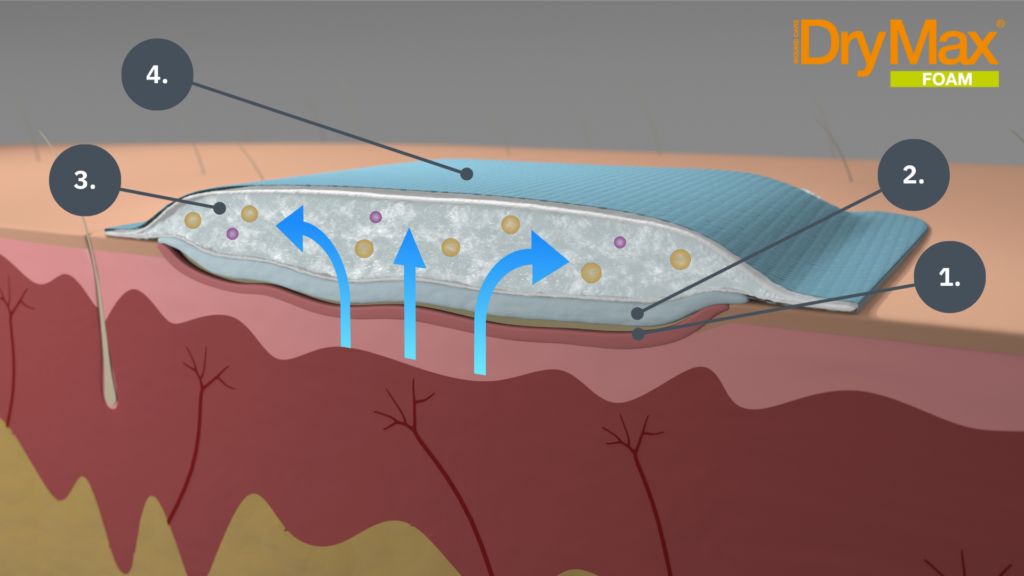 Superabsorbent Foam Dressing for advanced fluid management