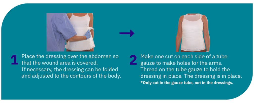 A folding guide for wound dressings | Wound management