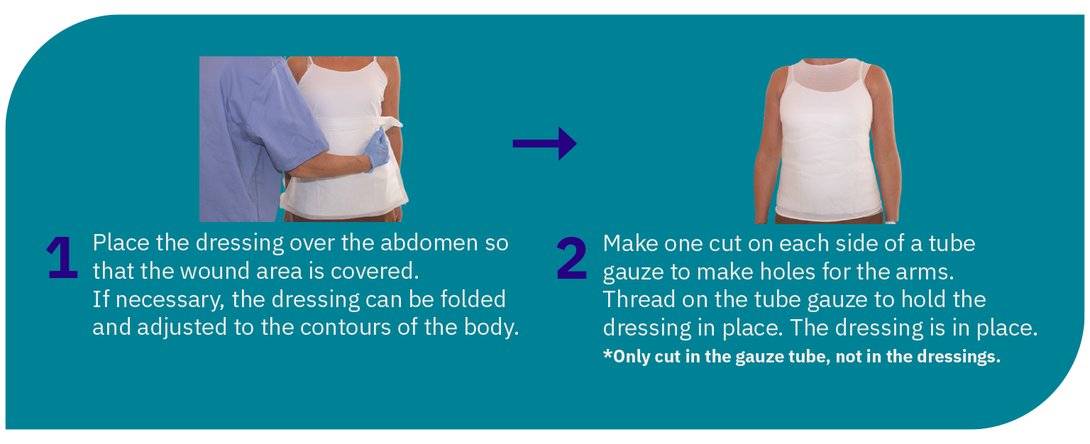 A folding guide for wound dressings | Wound management